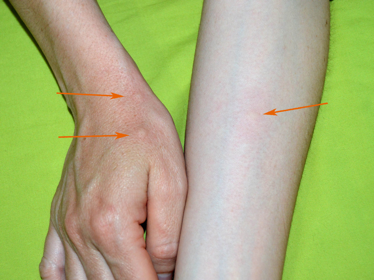 Habones producidos por flebotomo (Diptera, Phlebotominae) – El ...