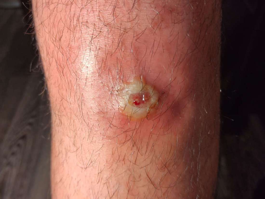 Loxoscelismo cutáneo causado por Loxosceles rufescens (Araneae ...