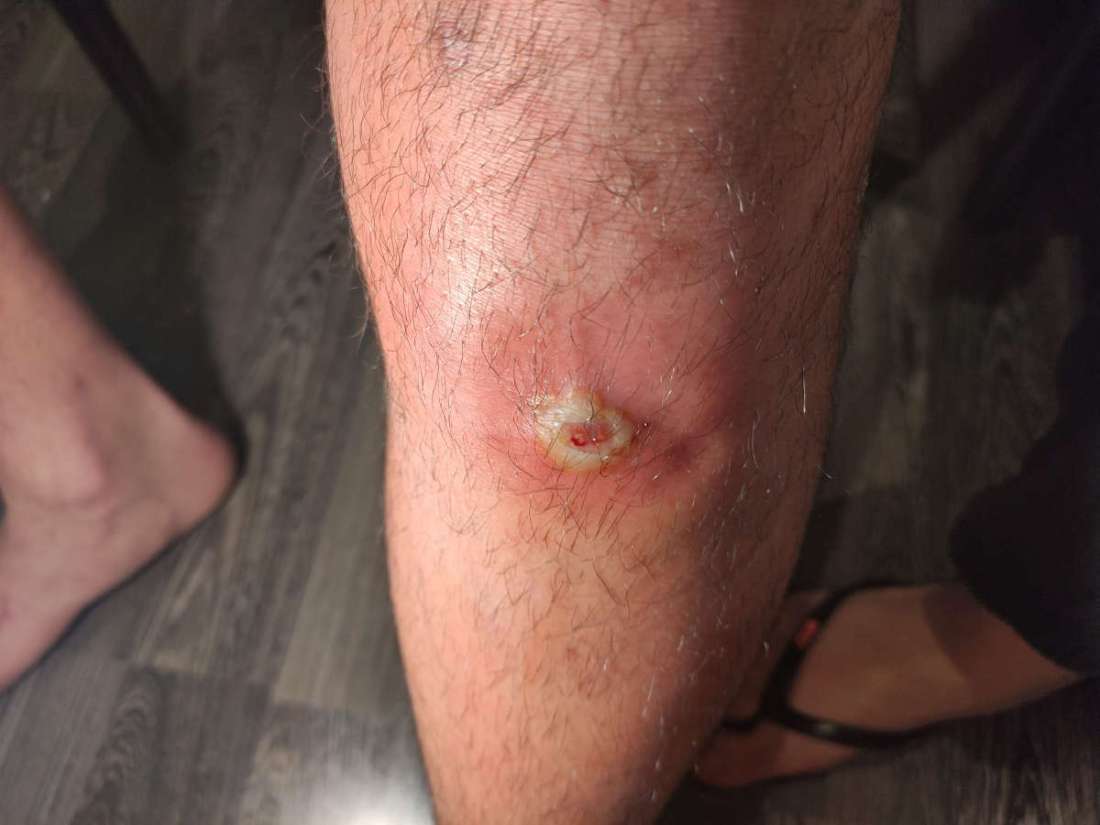 Loxoscelismo cutáneo causado por Loxosceles rufescens (Araneae ...